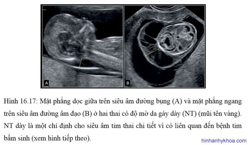 [Sách dịch] Hướng dẫn thực hành siêu âm tim thai - Siêu âm tim ở tuổi ...