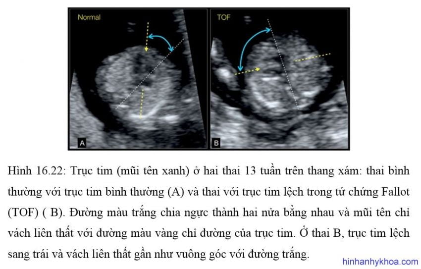 [Sách dịch] Hướng dẫn thực hành siêu âm tim thai - Siêu âm tim ở tuổi ...