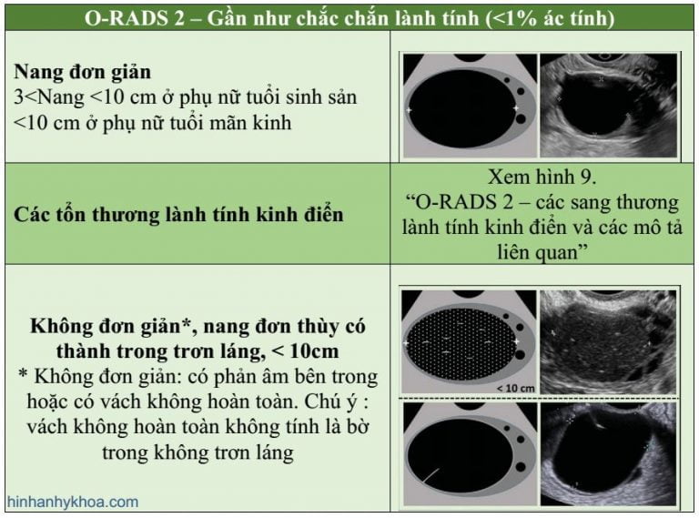 ORADS US Hệ thống phân loại và xử trí các khối u buồng trứng dựa trên ...