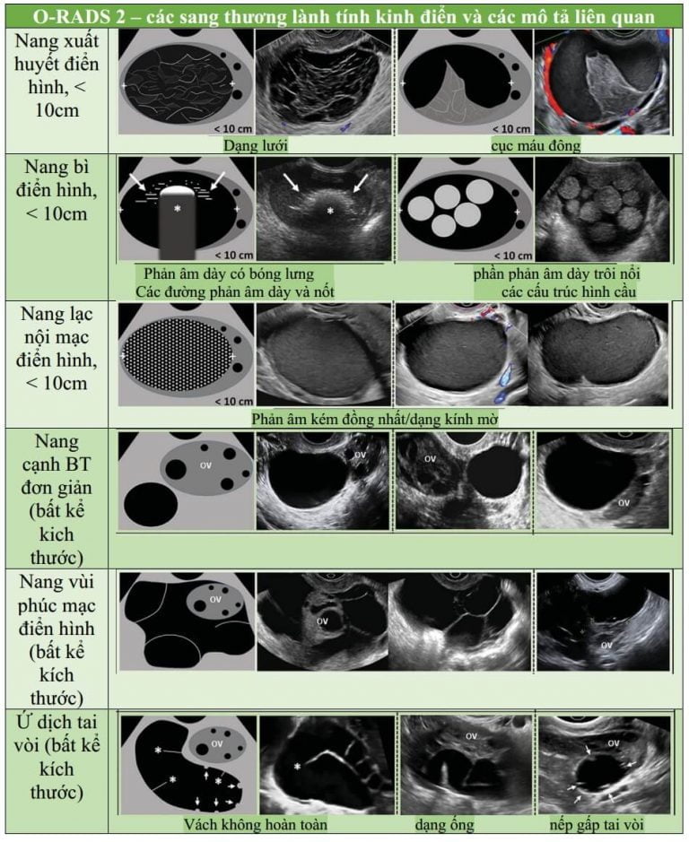 ORADS US Hệ thống phân loại và xử trí các khối u buồng trứng dựa trên ...