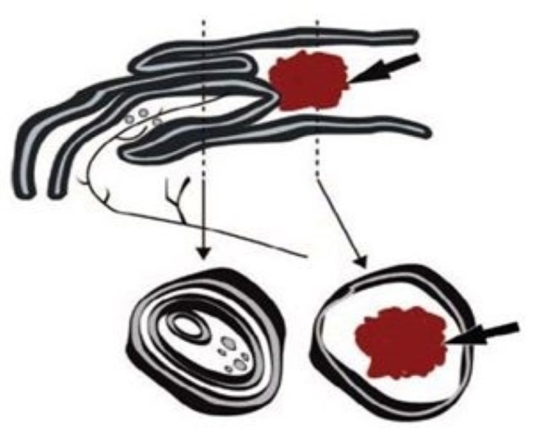 Hình ảnh lồng ruột ở người lớn | Hình ảnh Y khoa | Chẩn đoán hình ảnh ...